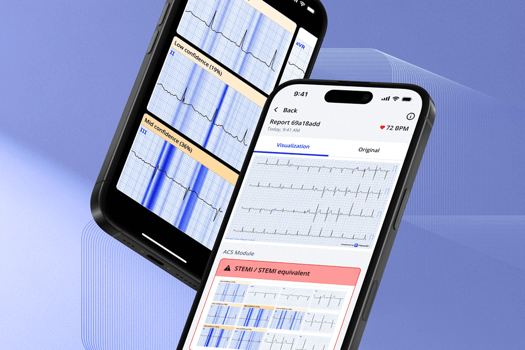 STEMI ECG Criteria: Key Insights into Ischemic ST-Elevation Patterns