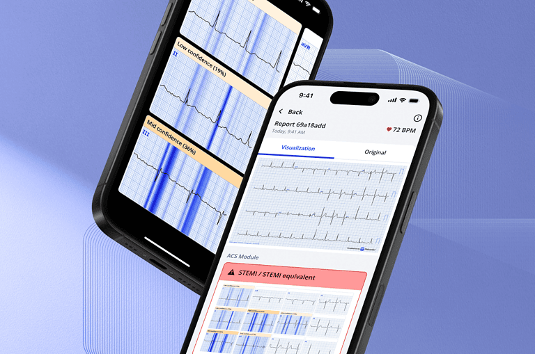 STEMI ECG Criteria: Key Insights into Ischemic ST-Elevation Patterns