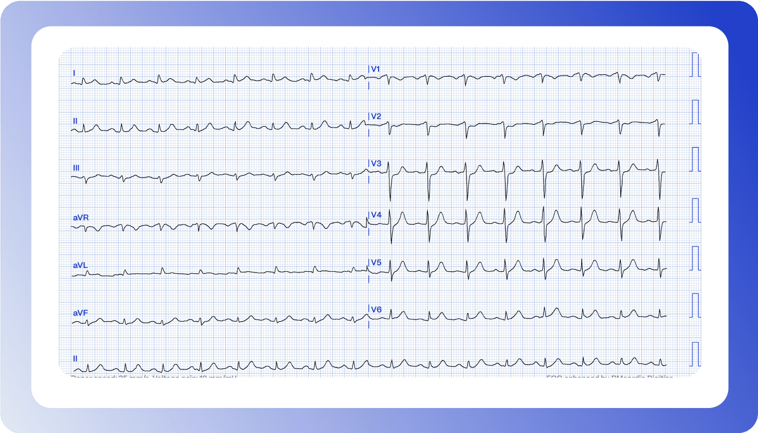 ECG Reader: AI-powered Expert Interpretation | PMcardio