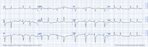 STEMI Equivalents: Navigating The Hidden | PMcardio