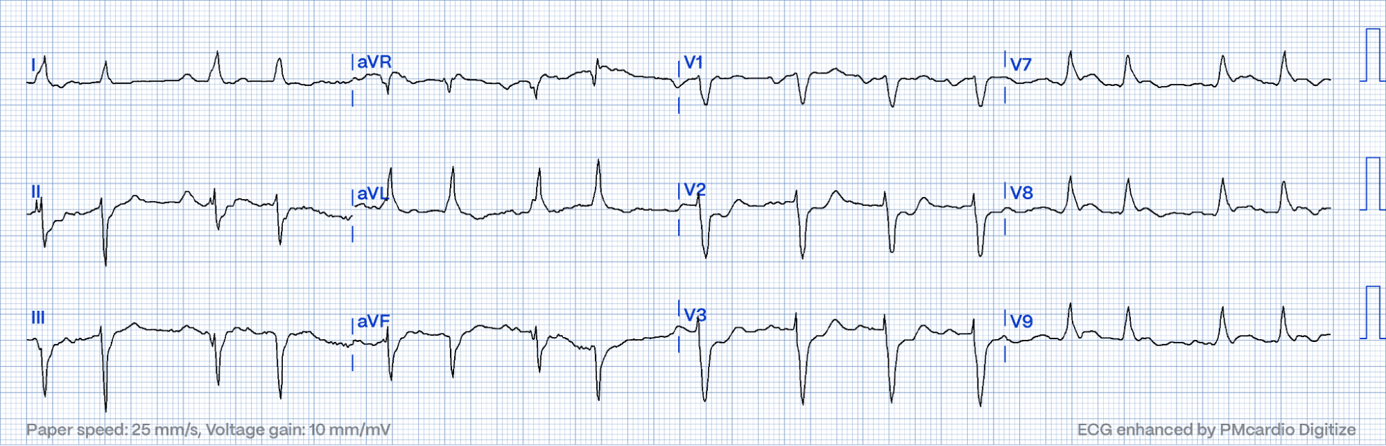 STEMI Equivalents: Navigating The Hidden | PMcardio