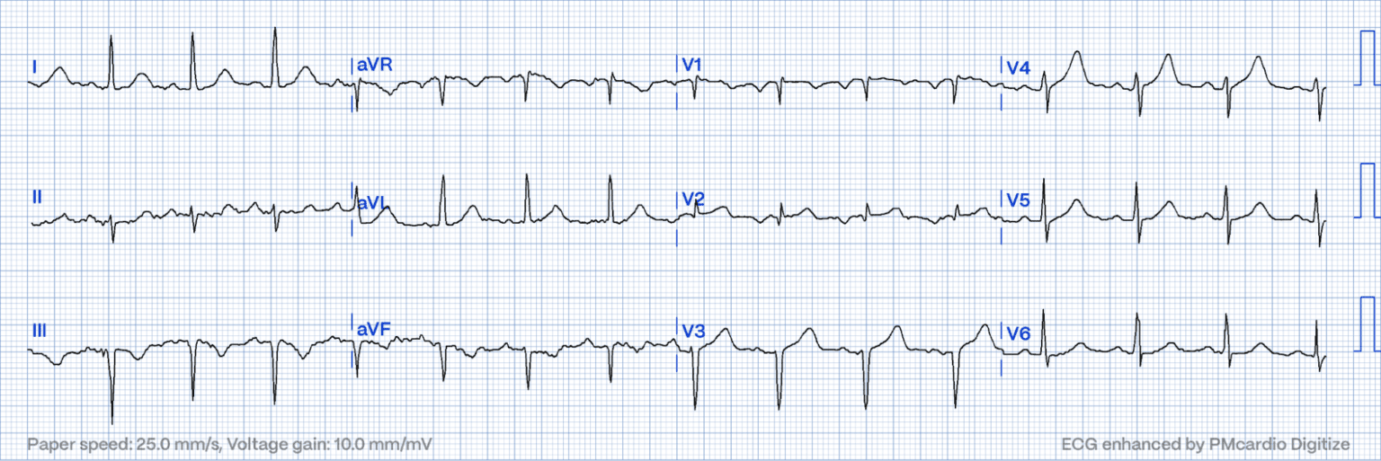 STEMI Equivalents: Navigating The Hidden | PMcardio
