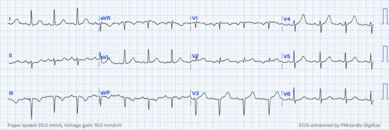 STEMI Equivalents: Navigating The Hidden | PMcardio