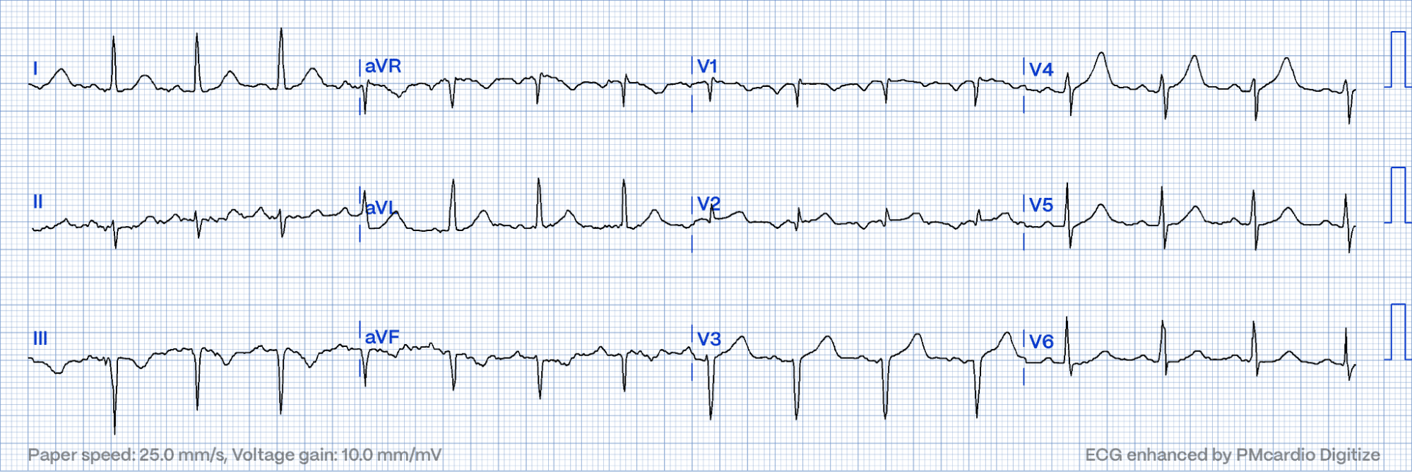 STEMI Equivalents: Navigating The Hidden | PMcardio