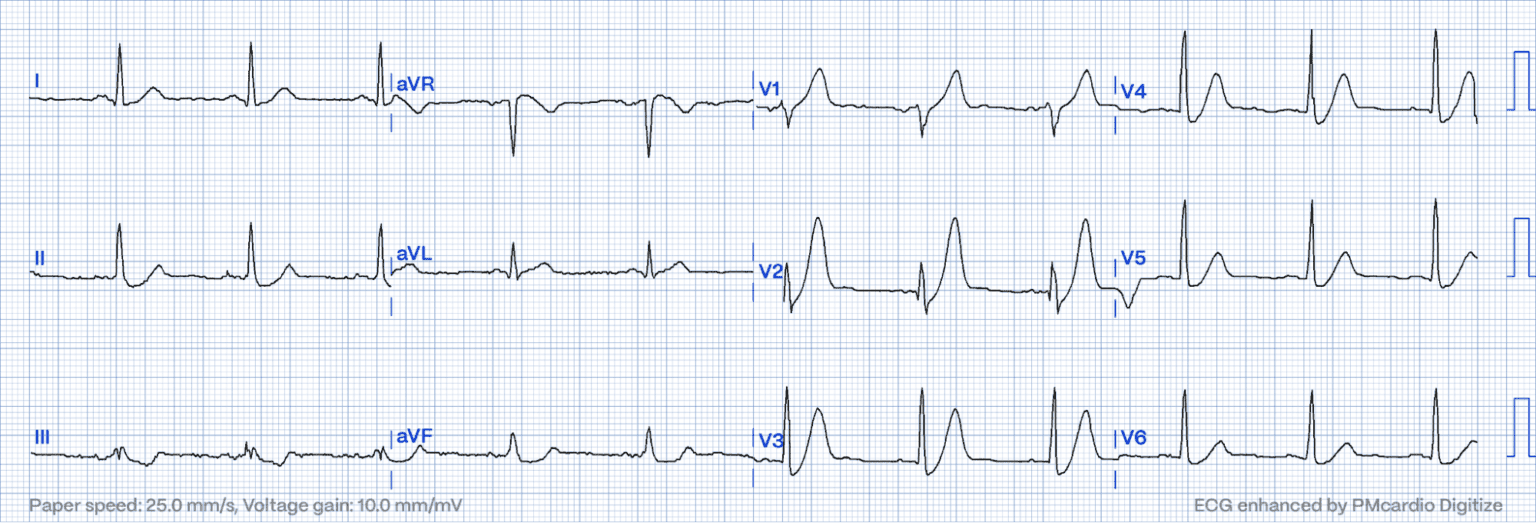 STEMI Equivalents: Navigating The Hidden | PMcardio