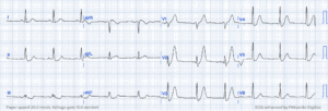 STEMI Equivalents: Navigating The Hidden | PMcardio