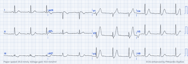 STEMI Equivalents: Navigating The Hidden | PMcardio