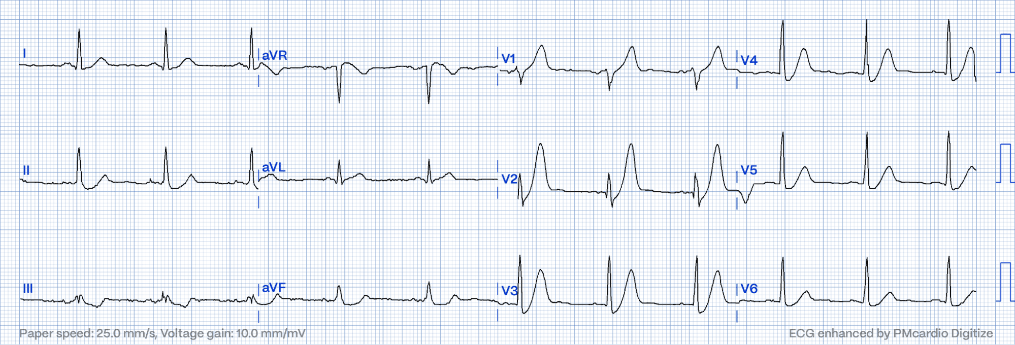 STEMI Equivalents: Navigating The Hidden | PMcardio