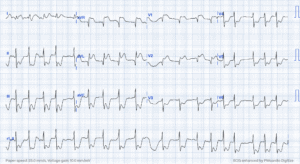 STEMI Equivalents: Navigating The Hidden | PMcardio