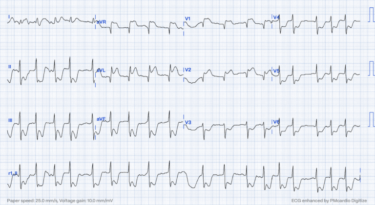 STEMI Equivalents: Navigating The Hidden | PMcardio