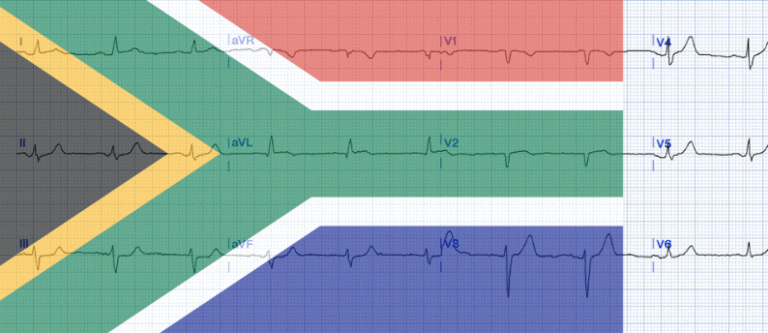 STEMI Equivalents: Navigating The Hidden | PMcardio