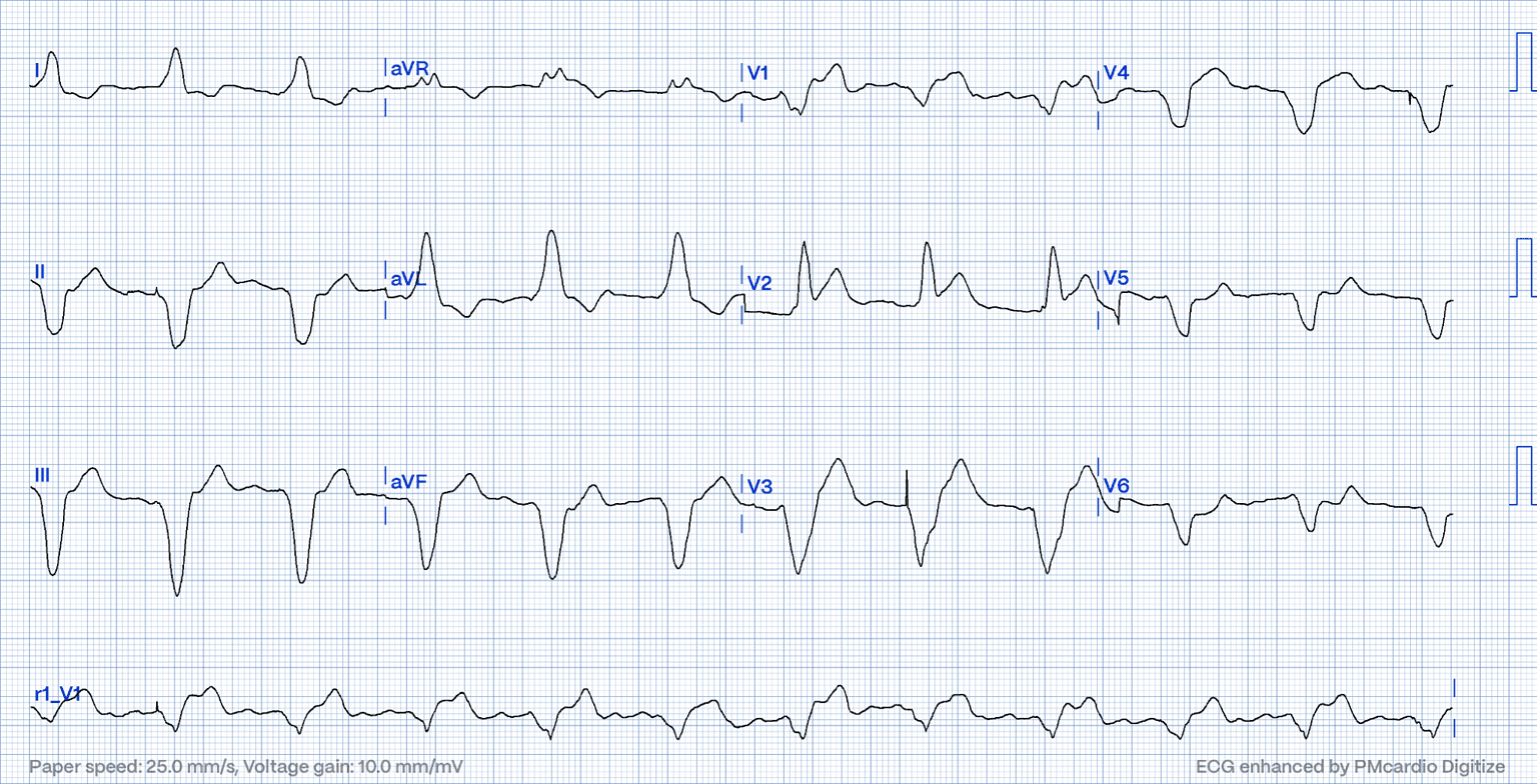 STEMI Equivalents: Navigating The Hidden | PMcardio