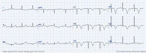 Wellens' Syndrome: How to Prevent Acute Coronary Occlusions