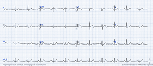 Wellens' Syndrome: How to Prevent Acute Coronary Occlusions
