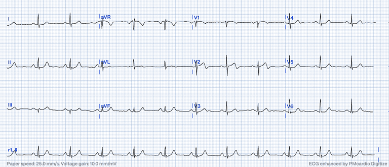 Wellens' Syndrome: How to Prevent Acute Coronary Occlusions