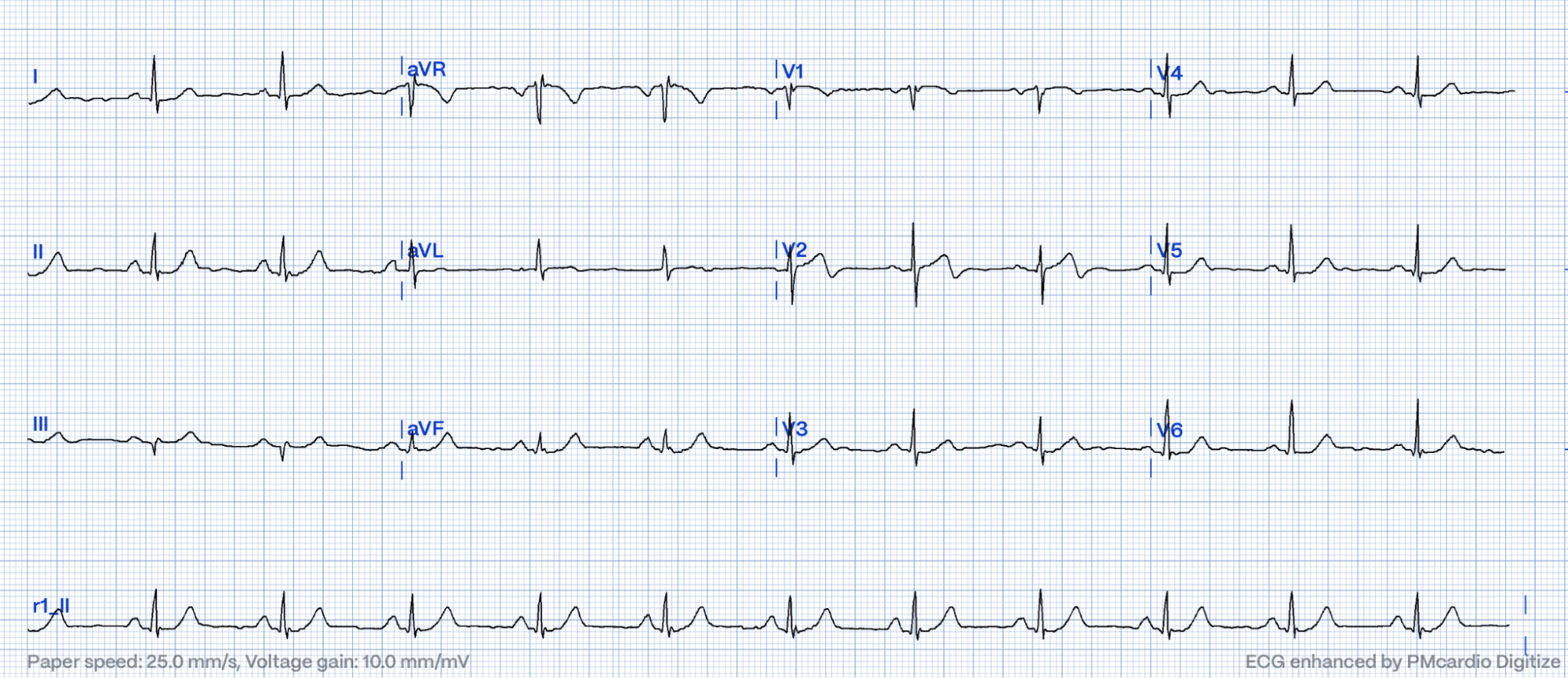 Wellens' Syndrome: How to Prevent Acute Coronary Occlusions