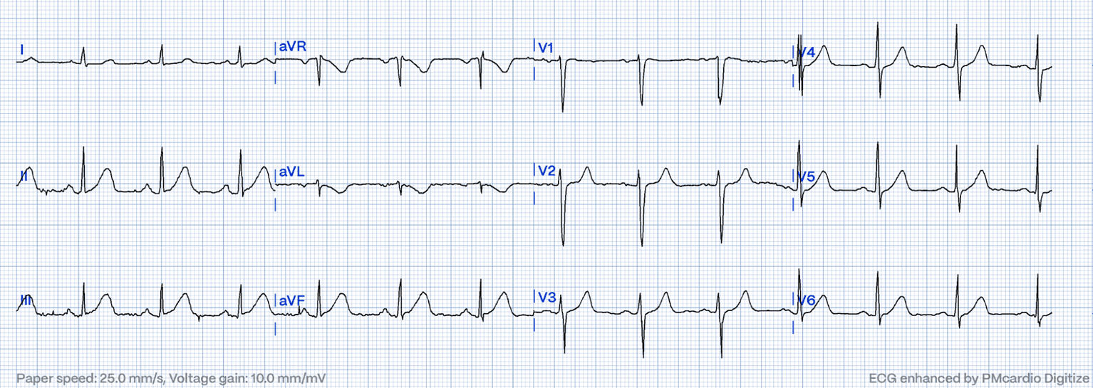 Hyperacute T-Waves: A Comprehensive Pattern Exploration