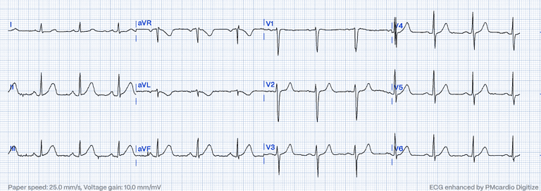 Hyperacute T-Waves: A Comprehensive Pattern Exploration