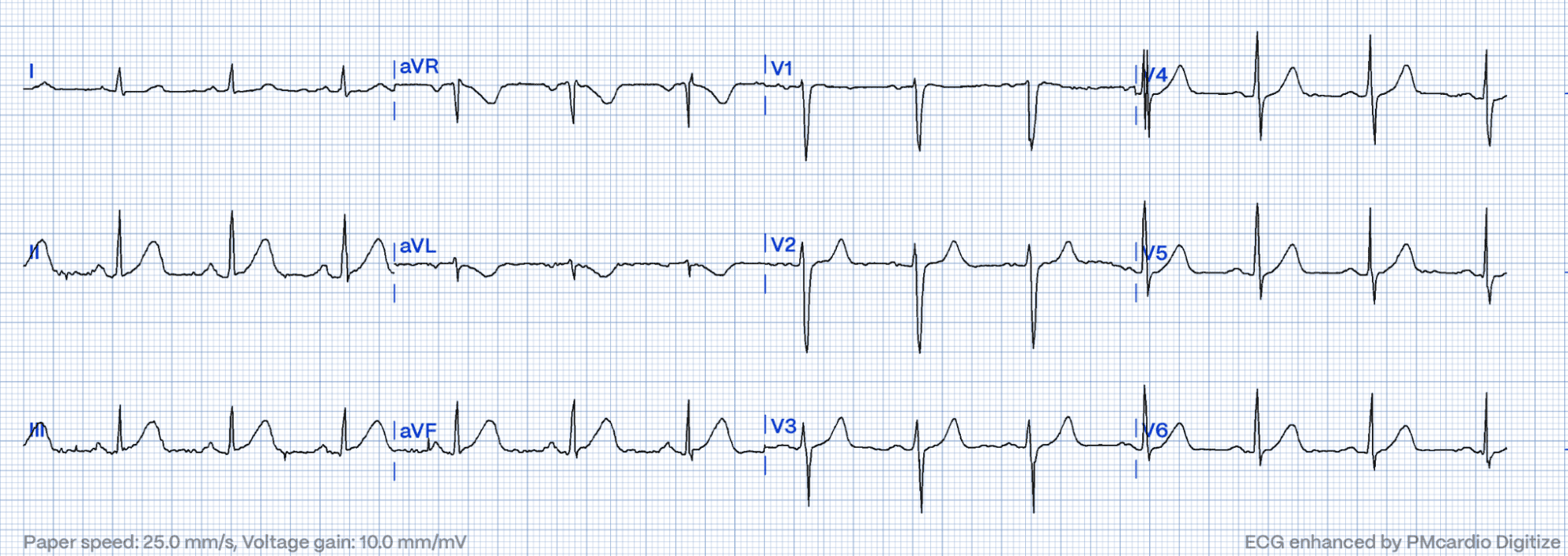 Hyperacute T-Waves: A Comprehensive Pattern Exploration