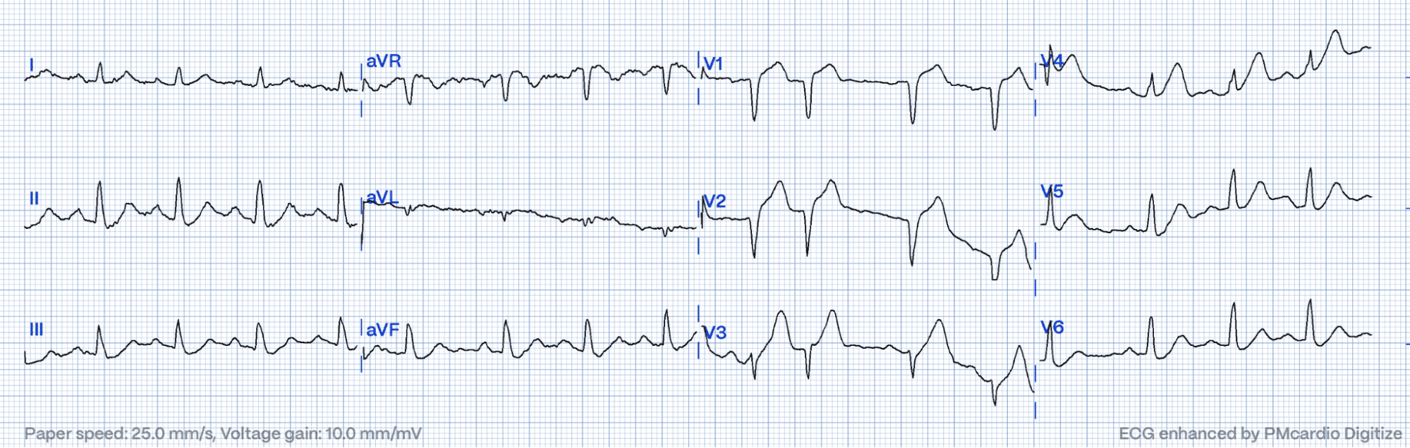 Hyperacute T-Waves: A Comprehensive Pattern Exploration