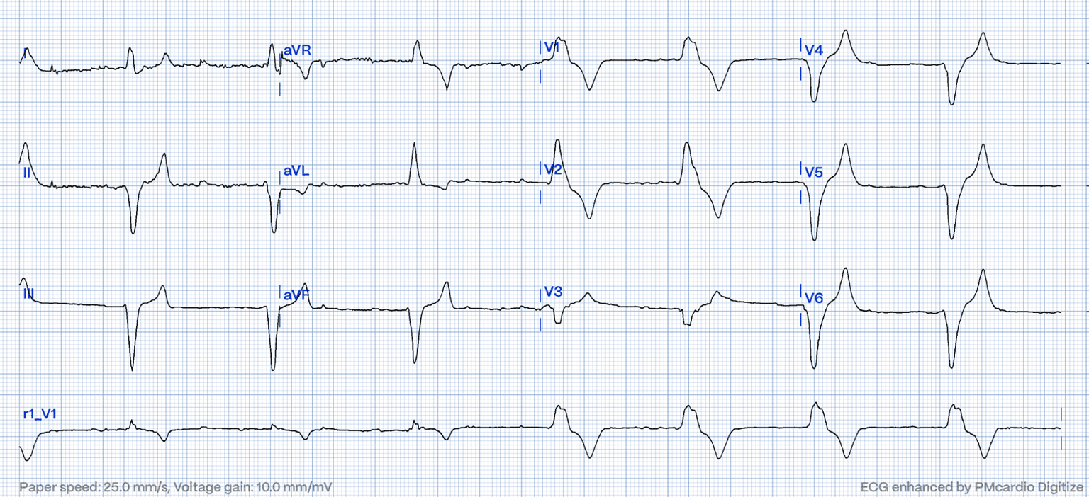 Hyperacute T-Waves: A Comprehensive Pattern Exploration