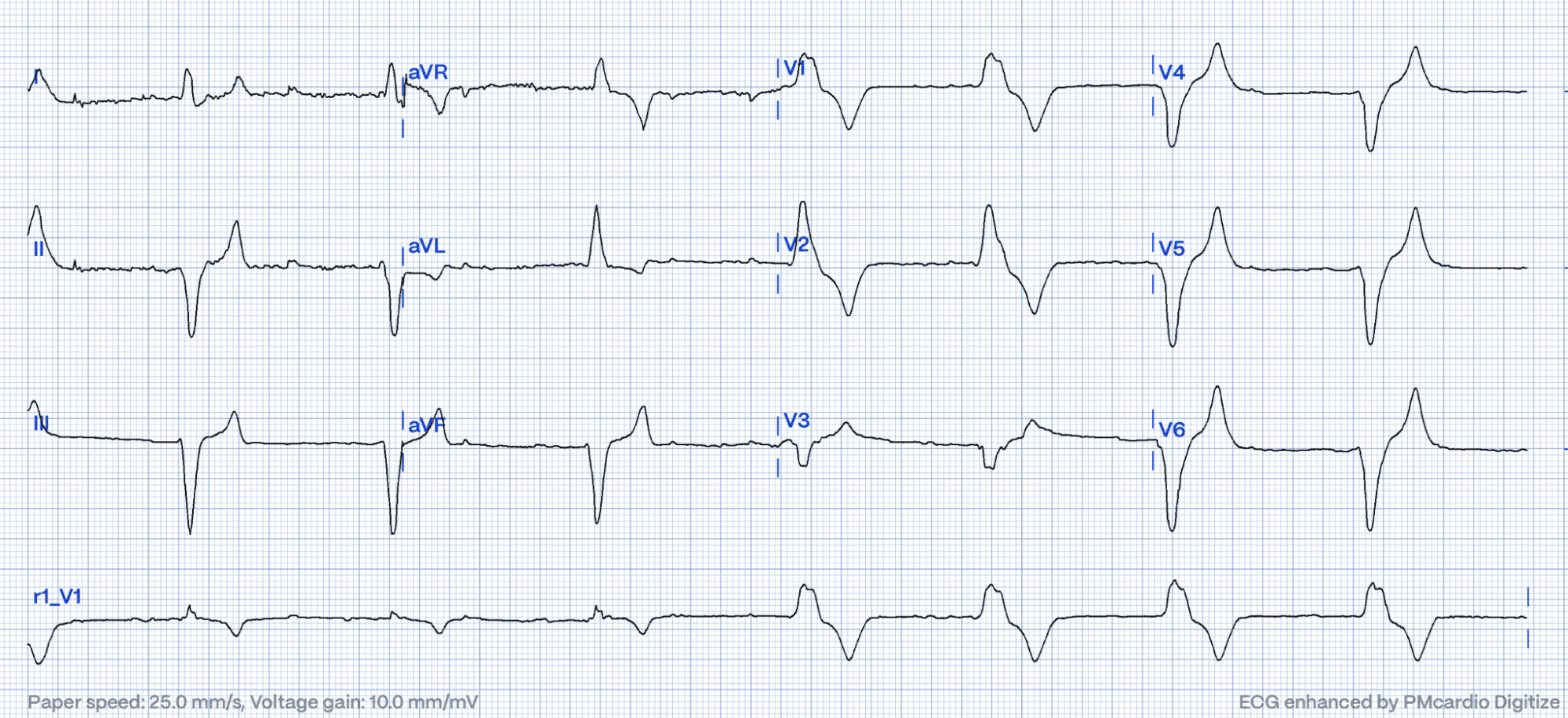 Hyperacute T-Waves: A Comprehensive Pattern Exploration