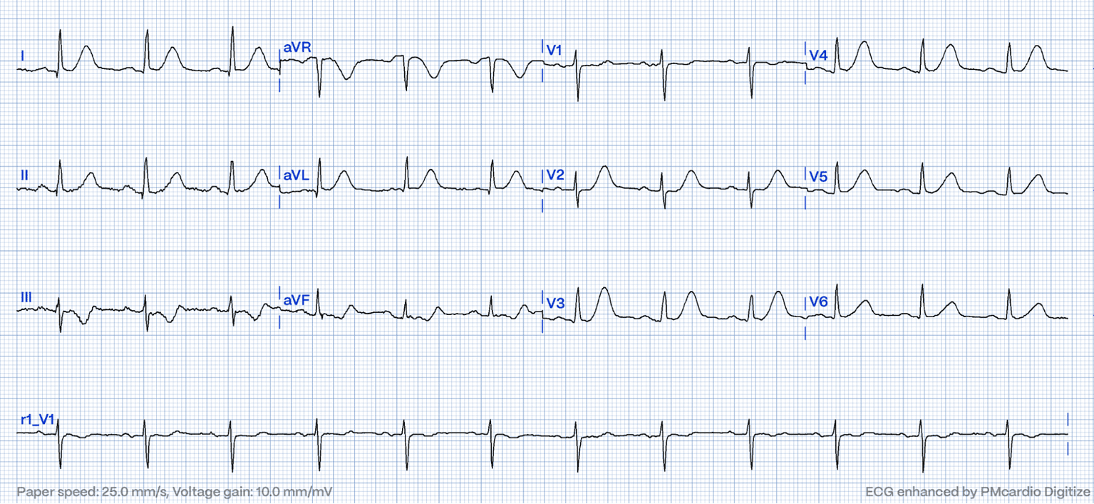 Hyperacute T-Waves: A Comprehensive Pattern Exploration