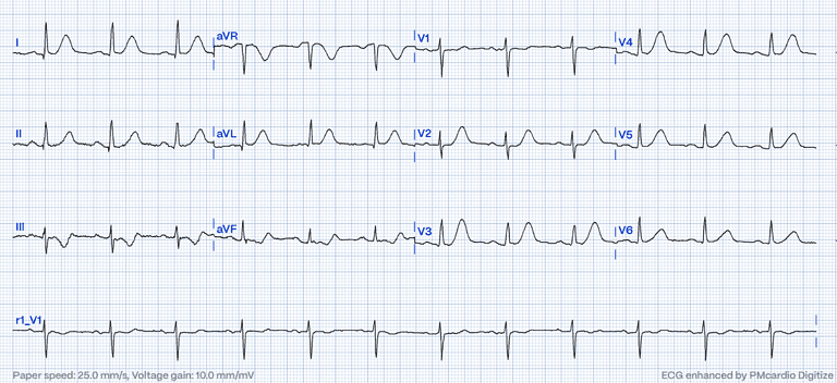 Hyperacute T-Waves: A Comprehensive Pattern Exploration
