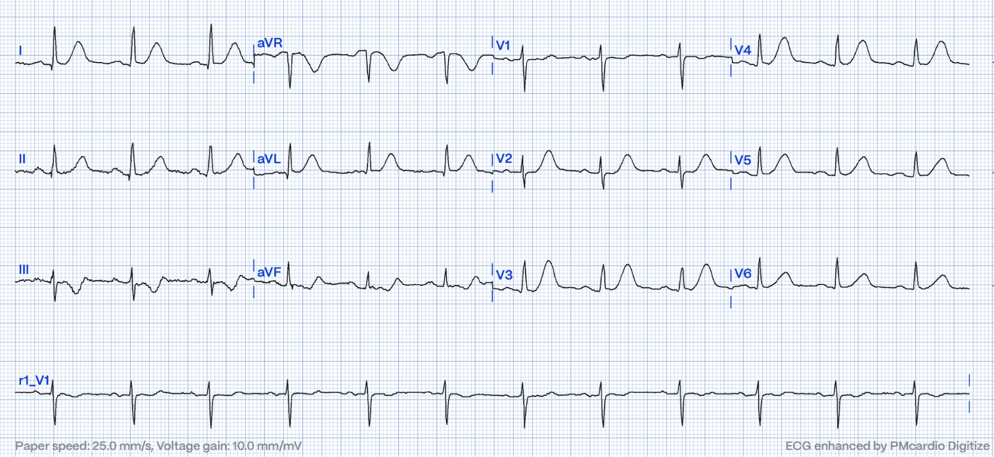 Hyperacute T-Waves: A Comprehensive Pattern Exploration