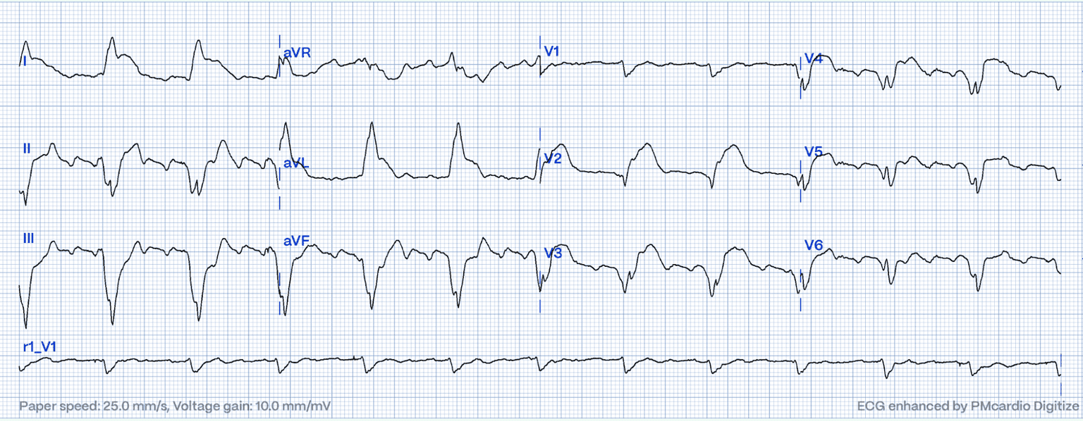 Sgarbossa Criteria: Advanced Cardiac Diagnosis | PMcardio