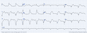 Sgarbossa Criteria: Advanced Cardiac Diagnosis | PMcardio