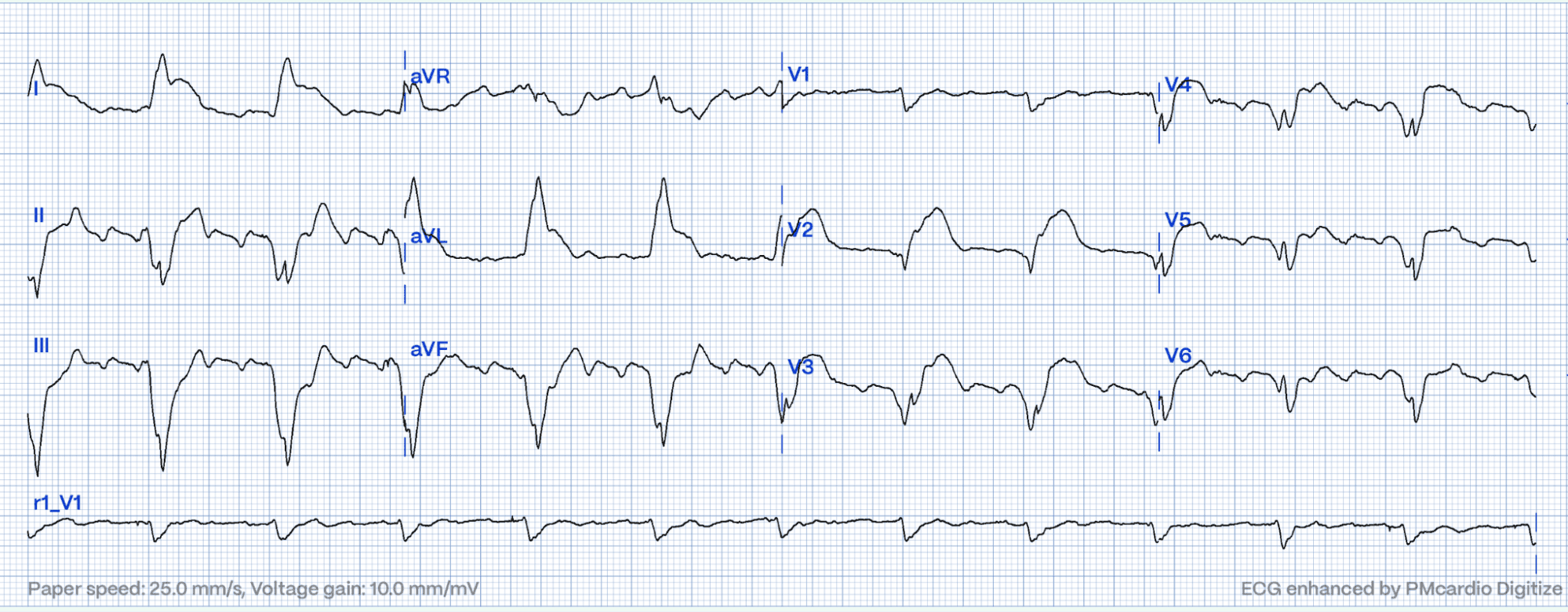 Sgarbossa Criteria: Advanced Cardiac Diagnosis | PMcardio