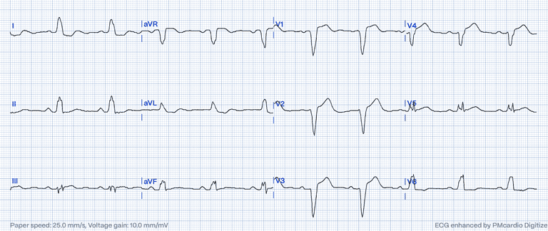 Sgarbossa Criteria: Advanced Cardiac Diagnosis | PMcardio