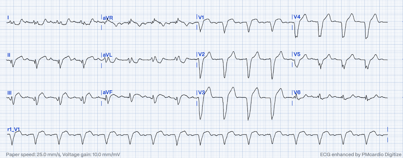 Sgarbossa Criteria: Advanced Cardiac Diagnosis | PMcardio