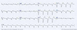 Sgarbossa Criteria: Advanced Cardiac Diagnosis | PMcardio