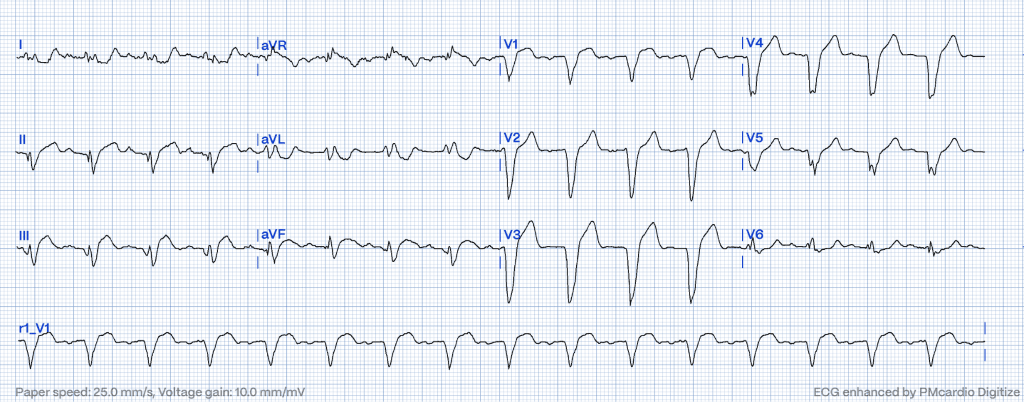 Sgarbossa Criteria: Advanced Cardiac Diagnosis | PMcardio