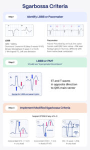 Sgarbossa Criteria: Advanced Cardiac Diagnosis | PMcardio