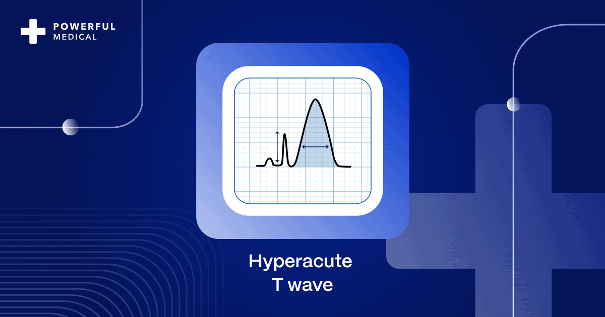 Hyperacute T-Waves: A Comprehensive Pattern Exploration