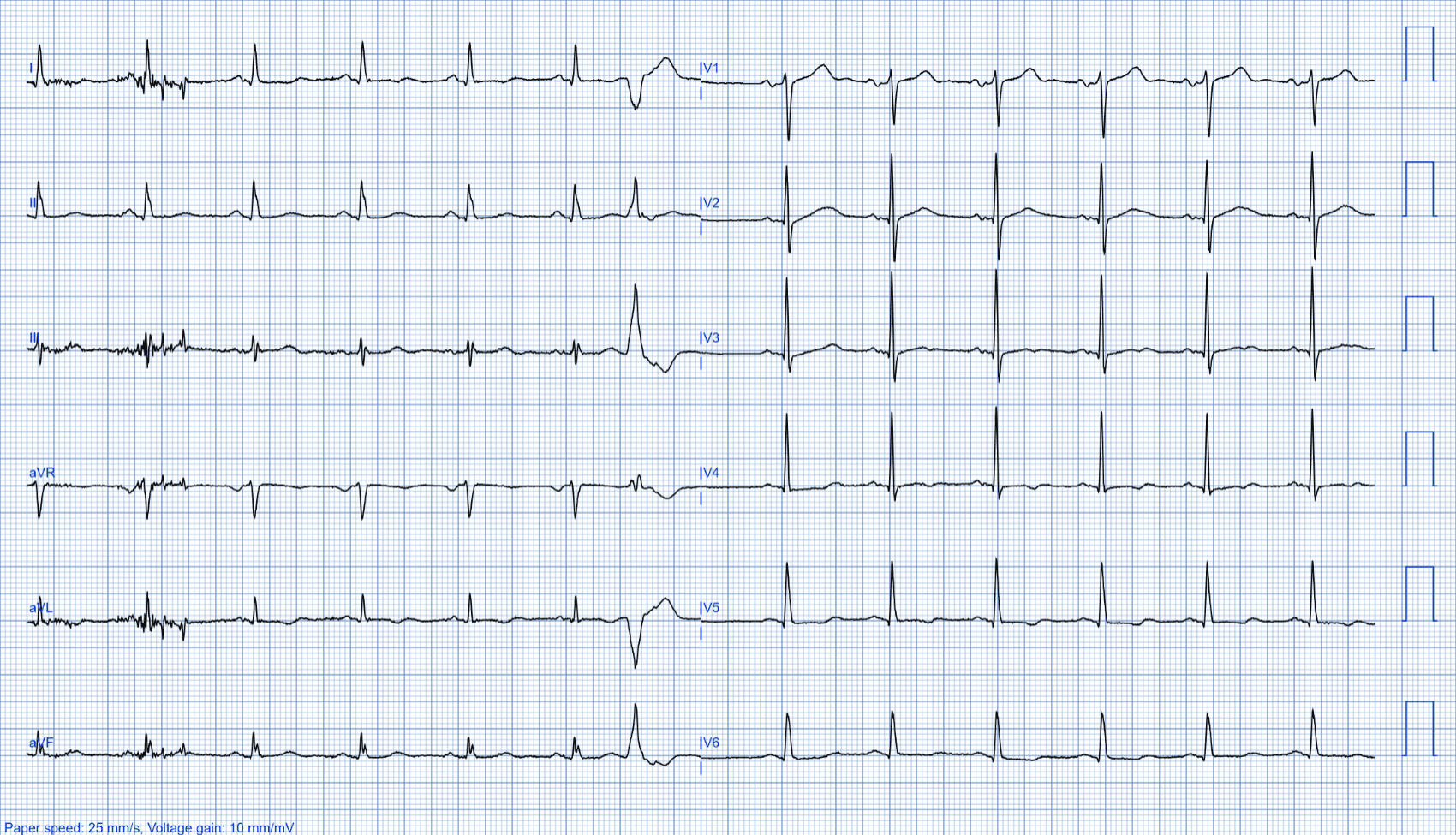 Left Ventricular Systolic Dysfunction (LVSD): The Basics and AI
