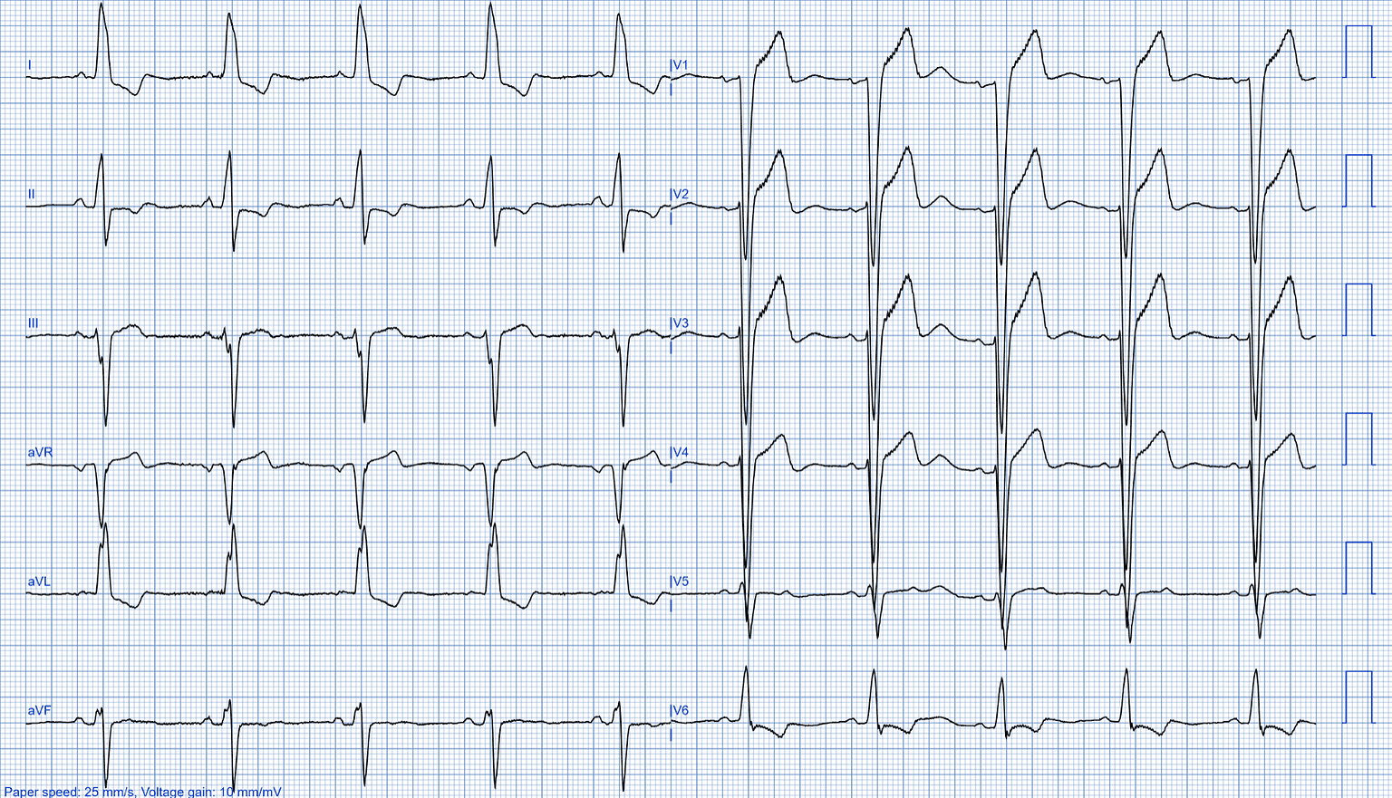 Left Ventricular Systolic Dysfunction (LVSD): The Basics and AI