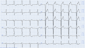 Left Ventricular Systolic Dysfunction (LVSD): The Basics and AI
