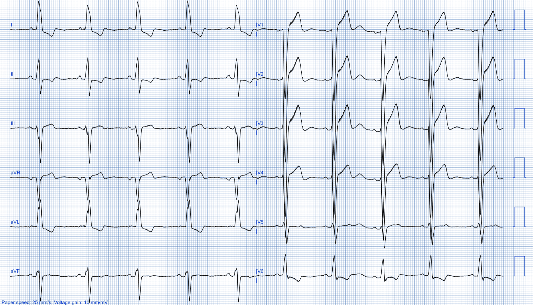 Left Ventricular Systolic Dysfunction (LVSD): The Basics and AI