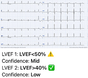 Left Ventricular Systolic Dysfunction (LVSD): The Basics and AI