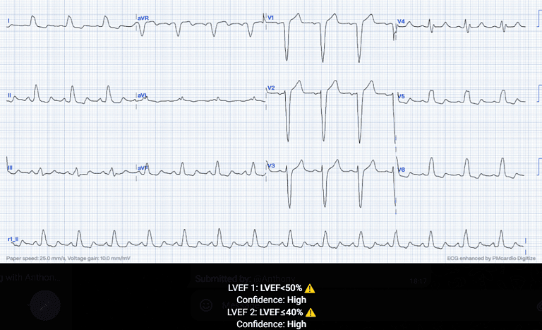 Left Ventricular Systolic Dysfunction (LVSD): The Basics and AI