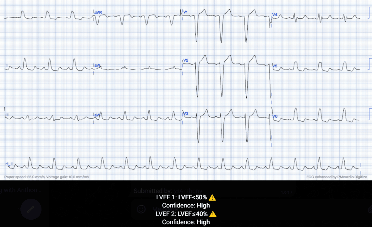 Left Ventricular Systolic Dysfunction (LVSD): The Basics and AI