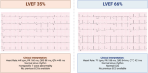 Left Ventricular Systolic Dysfunction (LVSD): The Basics and AI