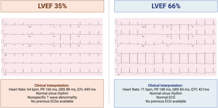 Left Ventricular Systolic Dysfunction (LVSD): The Basics and AI