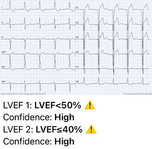 Left Ventricular Systolic Dysfunction (LVSD): The Basics and AI