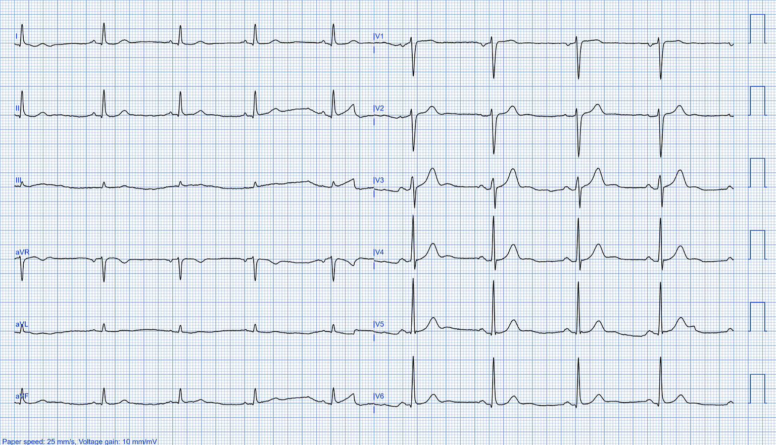 Left Ventricular Systolic Dysfunction (LVSD): The Basics and AI