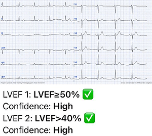 Left Ventricular Systolic Dysfunction (LVSD): The Basics and AI